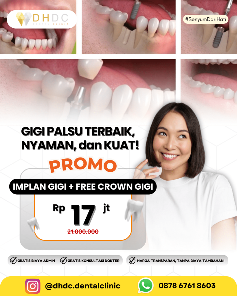 Rekomendasi Klinik Dokter Implan Gigi Terdekat di Jakarta
